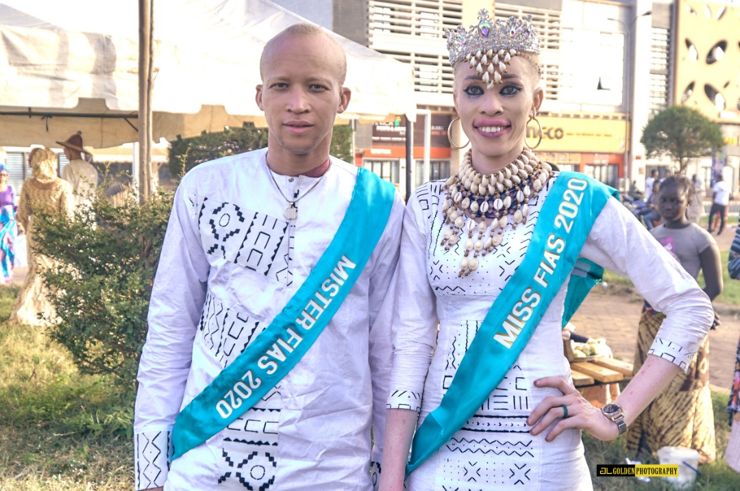 Living with Albinism = living a life of quality! - Voice.Global